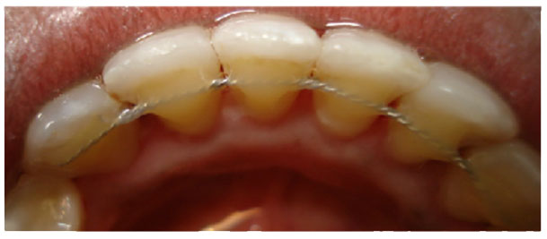 Parodontie – Cabinet dentaire en Tunisie